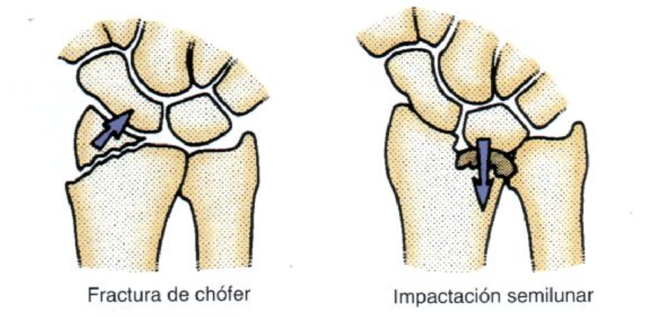 Fracturas De Radio Distal